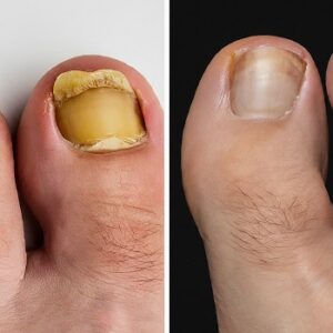 How to Diagnose Toenail Fungus Yourself – Symptoms and Tests – Proton ...